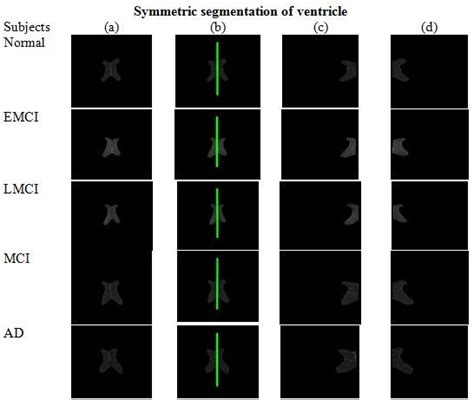 Symmetric Segmentation Of Ventricle A Ventricle Region B Symmetric Download Scientific