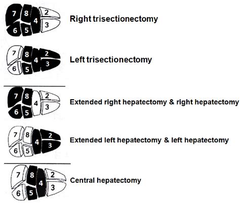 Figure 1 From Experiences Of 30 Years In Right Trisectionectomy For Huge Liver Tumor Semantic