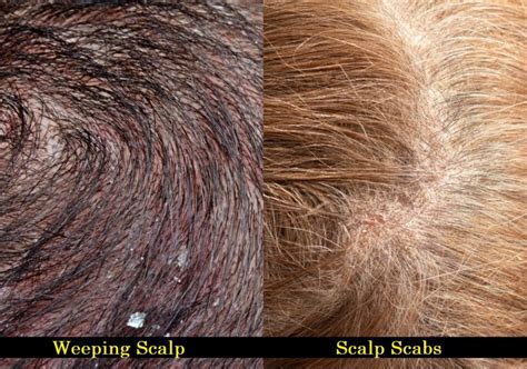 Why Is My Scalp Weeping Clear Fluid 9 Common Causes