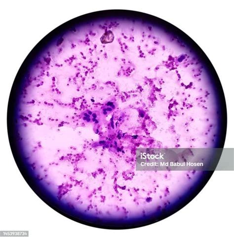 갑상선 결절 세포 여포 병변 현미경은 규칙적인 갑상선 여포 상피 세포의 세포 물질을 보여주고 배경은 조직 구와 혈액을 보여줍니다