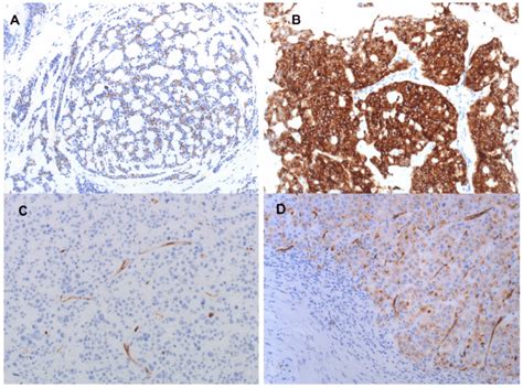 Immunohistochemical Psma Expression In Primary Tumors Of Acc Patients Download Scientific