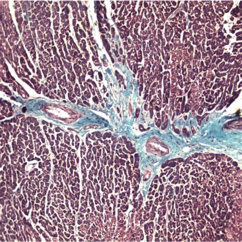 Section From Infundibular Tissue Showing Vacuolisation In Download