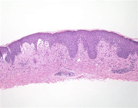 Pemphigoid Histology