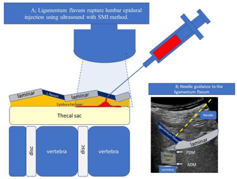 Epidurale Procedure