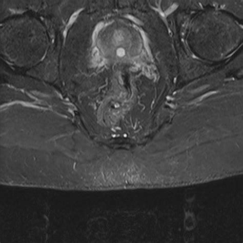 Utricle Cyst Prostate Prostatic Utricle Cyst Image