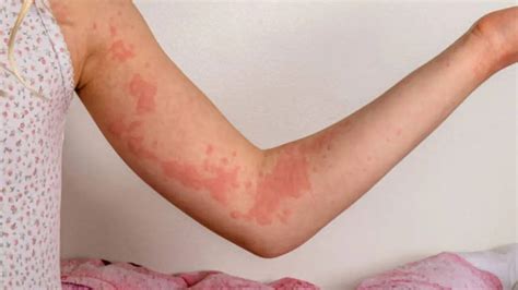 Water Allergy In Young Woman Breaks Out In Hives And Swelling Know