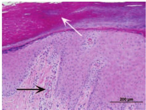 Photomicrograph Of Skin Biopsy Specimen From An Alpaca With