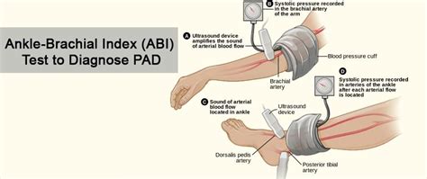 Peripheral Arterial Disease Pad Ms Ramaiah Memorial Hospital