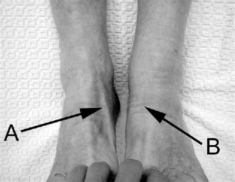 Tibialis Anterior Tendon Tear