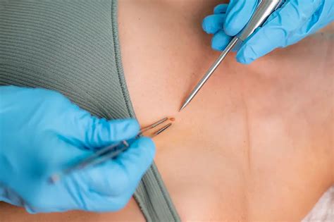 Medical Coding Rules For Lesion Excision