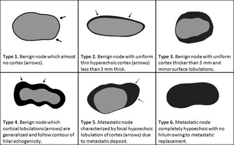 Swollen Lymph Nodes Armpit Ultrasound