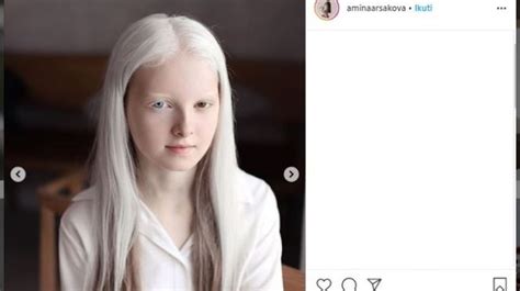 Bikin Takjub Perhatikan Warna Bola Mata Gadis Albino Ini