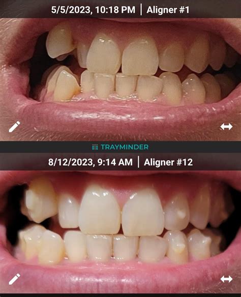 Progress Pics R Invisalign