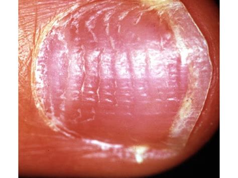 Nail Abnormalities Mclean And Woodbridge Va