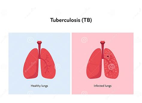 Concepto De Enfermedad De La Tuberculosis. Ilustración Vectorial De Asistencia Sanitaria Plana ...