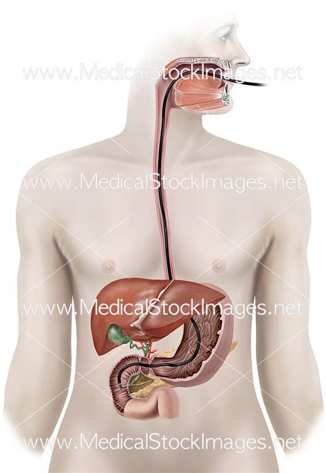 Endoscopic Retrograde Cholangiopancreatography Medical Stock Images Company