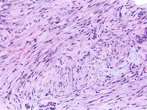Intra Articular Nodular Fasciitis Of The Knee A Rare Clinical