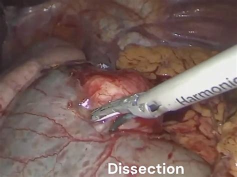 Cirurgia Cooperativa Laparoscópica E Endoscópica Lecs Para Ressecção De Gist Gástrico