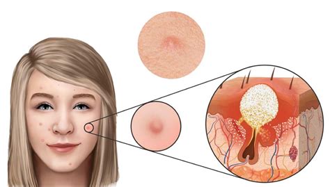 Intel Beauty Limited On Linkedin Papuleacne Skincaretips