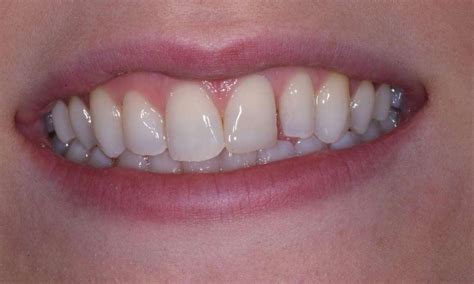 Closing Food Trap Between Teeth Before And After Photos Manchester Nh