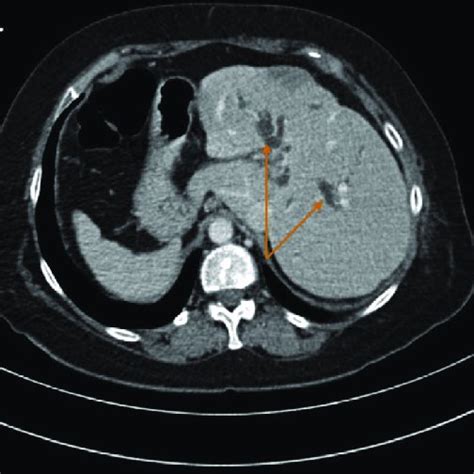 Coronal View Of The CT Of The Abdomen Showing The Dilated Intrahepatic Download Scientific