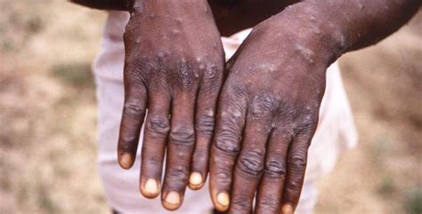 All You Need To Know About The Monkeypox Disease - Public Health