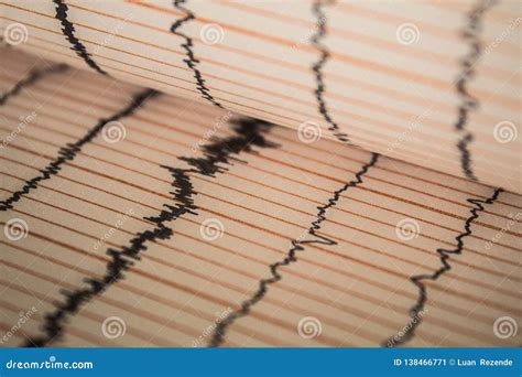 Sinus Heart Rhythm On Electrocardiogram Record Paper Showing Normal