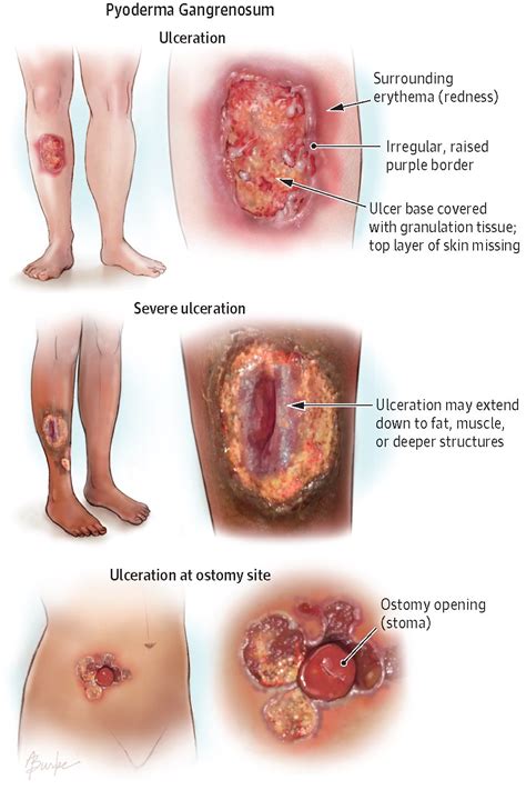 Ecthyma Impetigo Dermatologic Bacteriology Plastic Surgery Key