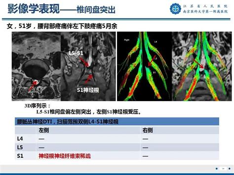 腰骶神经根压迫症的mri评估压迫症神经根评估患者 健康界