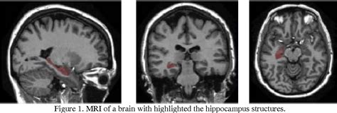 figure 1 from hippocampus segmentation via active contour model