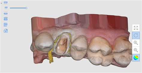 A Simple Premolar Crown Cad