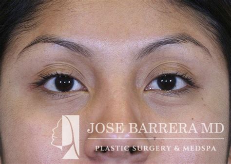 Blepharoplasty Case 3744 Dr Jose Barrera San Antonio Facial Plastic Surgeon And Ent