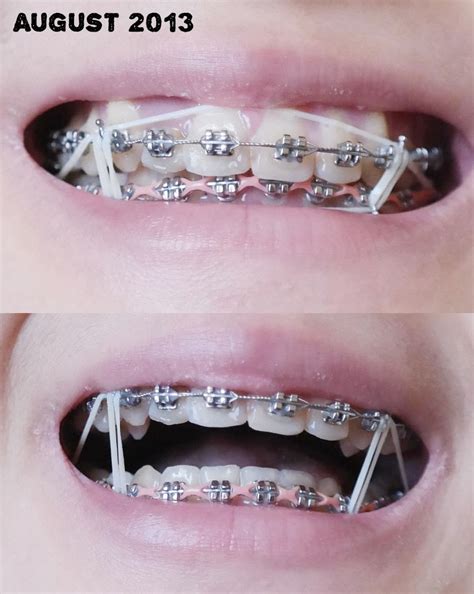 Xiao Vee Indonesian Beauty Blogger Diary Of My Braces Part 4 Year 2013
