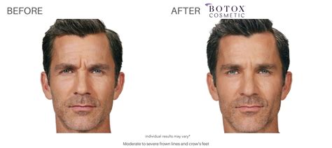 Botox Men Forehead