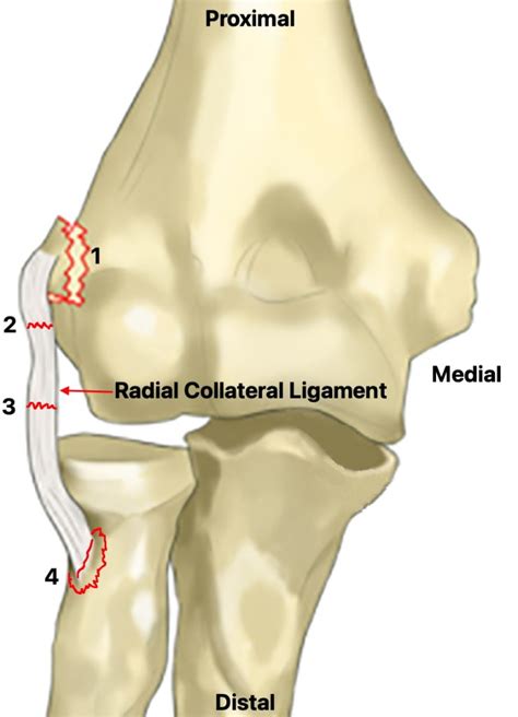 Ulnar Collateral Ligament Elbow
