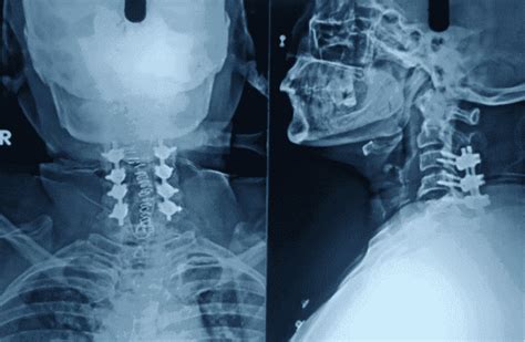 Cervical Laminoplasty Spine Surgery Spine Sure Clinic
