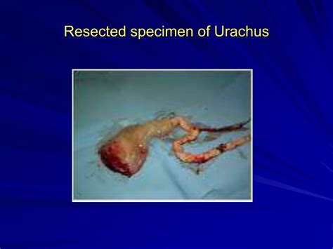 Congenital Anomalies Of Urinary Bladder Ppt