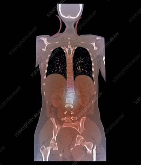 Traffic Accident Injuries CT Scan Stock Image C Science Photo Library