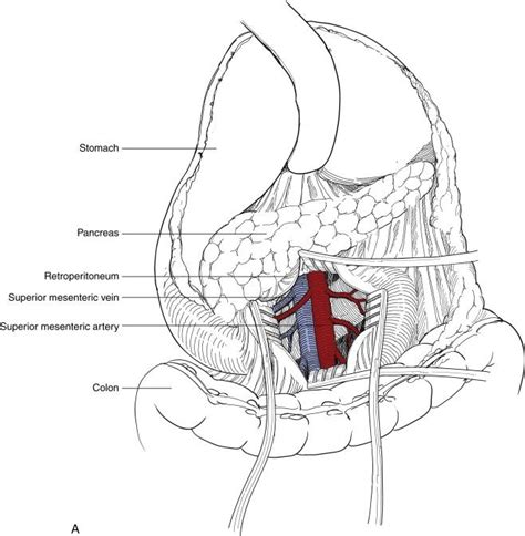 Direct Surgical Repair For Celiac Axis And Superior Mesenteric Artery