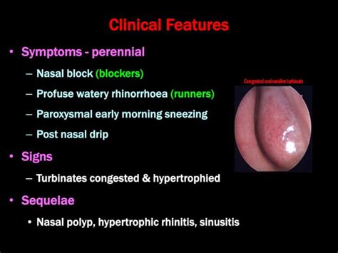 Allergic And Intrinsic Rhinitis Ppt
