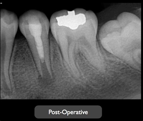 Revascularization Radix Endodontics