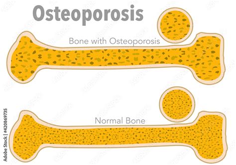 Vetor Osteoporosis Porous Bone Bone Anatomy Structure Comparison Of