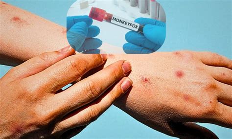 Understanding Mpox Signs Symptoms Treatment