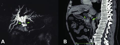 A Mrcp Of Patient 7 Showing Bismuth Type Iv Stenosis 2 5 Cm In Download Scientific Diagram