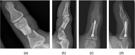 Figure 2 From Intramedullary Headless Screw Fixation For Fractures Of