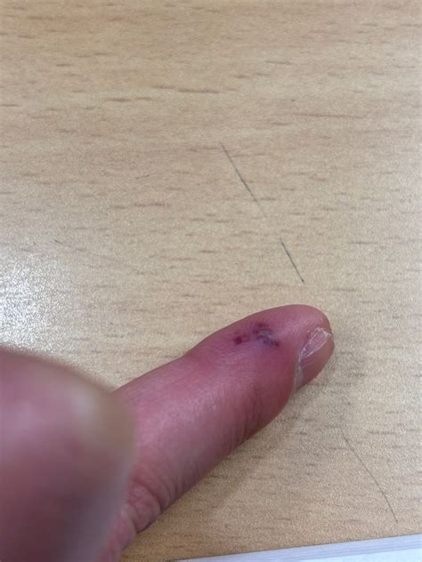 모기 벌레물림 지식in