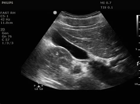 Gallbladder Ultrasound Transverse