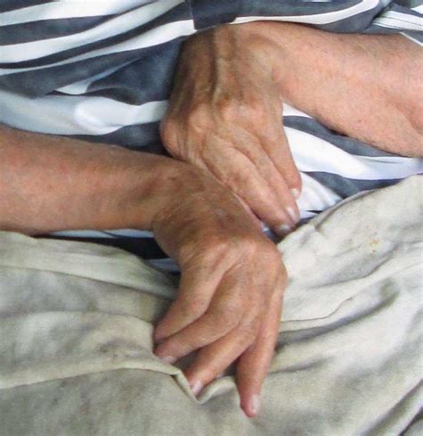 Ulnar Deviation What It Is Causes And Treatment