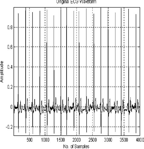 Figure 1 From Qrs Detection Using Digital Differentiators Semantic Scholar