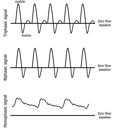 Measurement Of Ankle Pressures Assessment Doppler Waveforms And